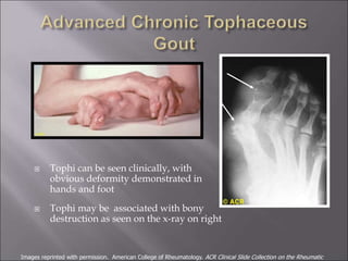 Gout and its rahabilitation | PPT