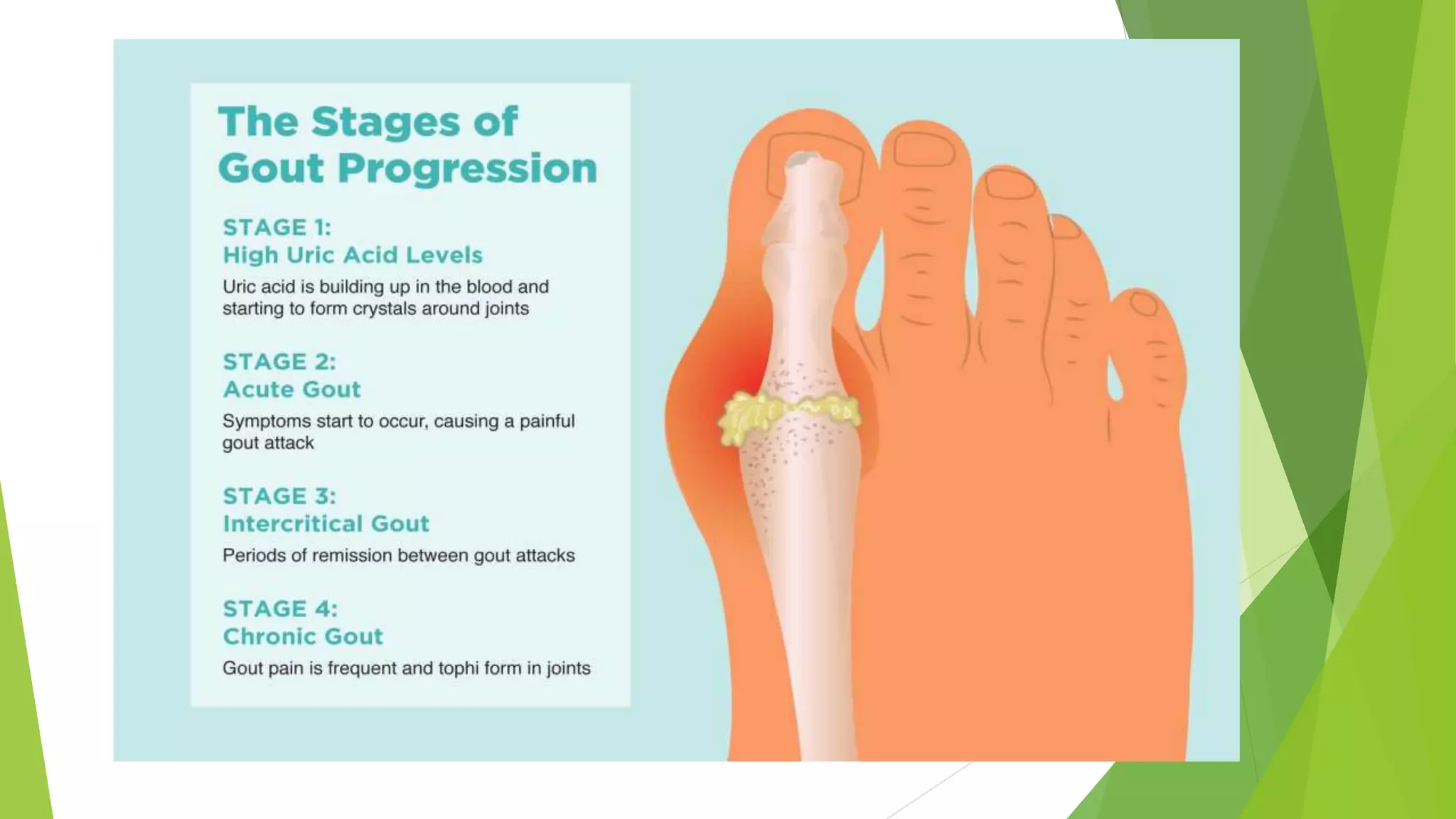 pharmacotherapy of gout | PPTX