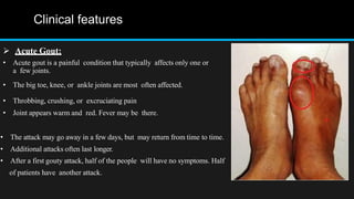 Gout | PPTX