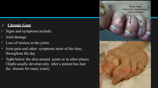 Gout | PPTX