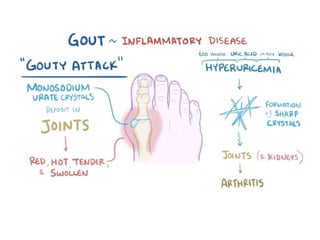 Clinical Pharmacotherapy of Gout disease.pptx