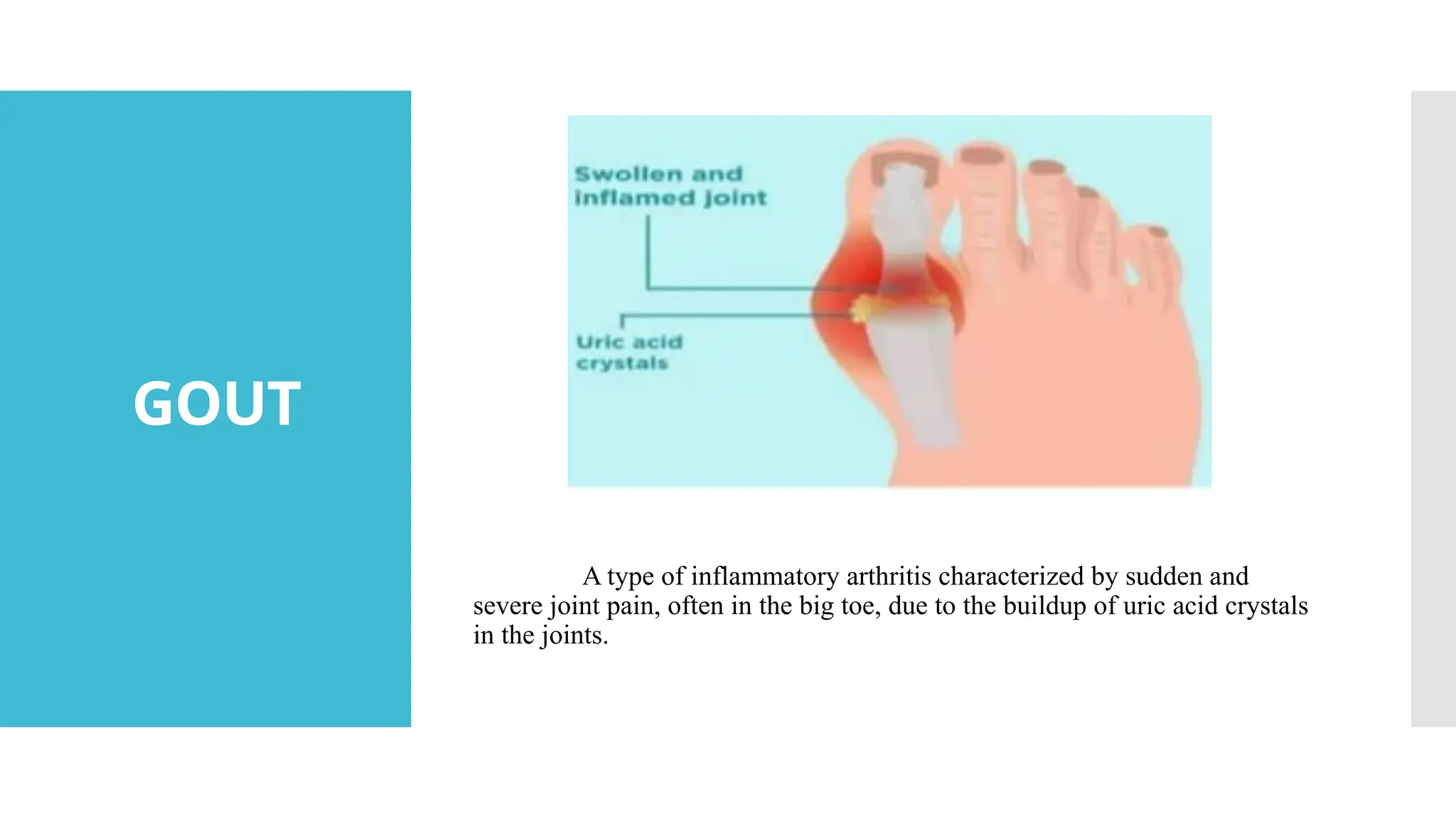 Gout: Understanding, Preventing, and Managing a Common Form of ...