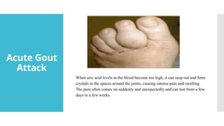 Gout: Understanding, Preventing, and Managing a Common Form of ...