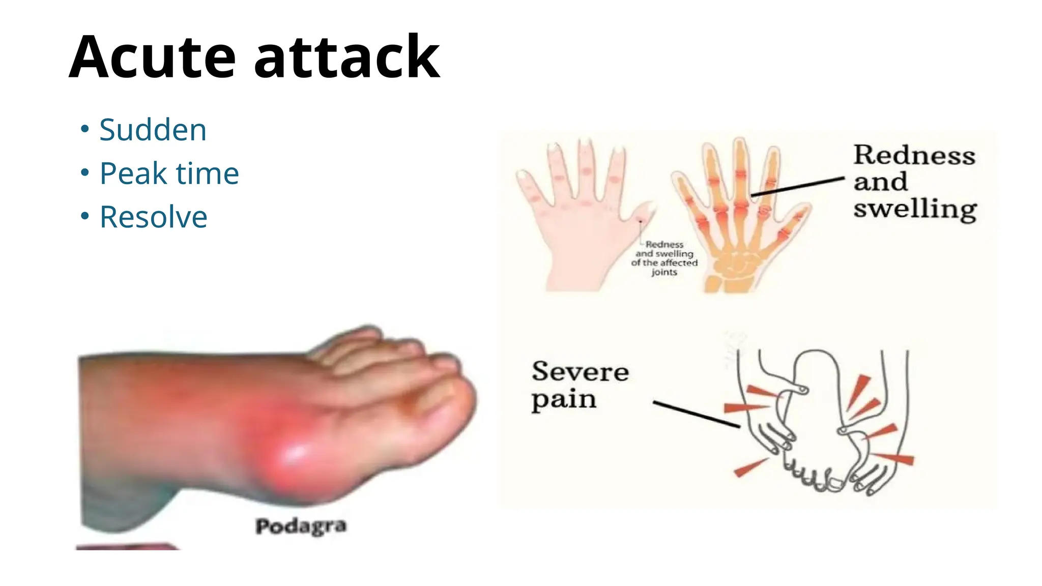 GOUT.definition, causes, pathogenesis, risk factor, clinical features, investigation, treatment ...