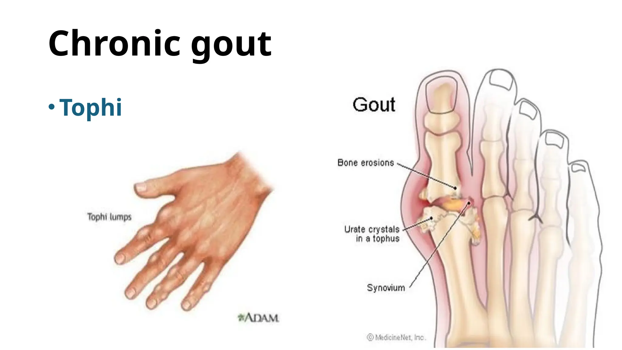 GOUT.definition, causes, pathogenesis, risk factor, clinical features, investigation, treatment ...