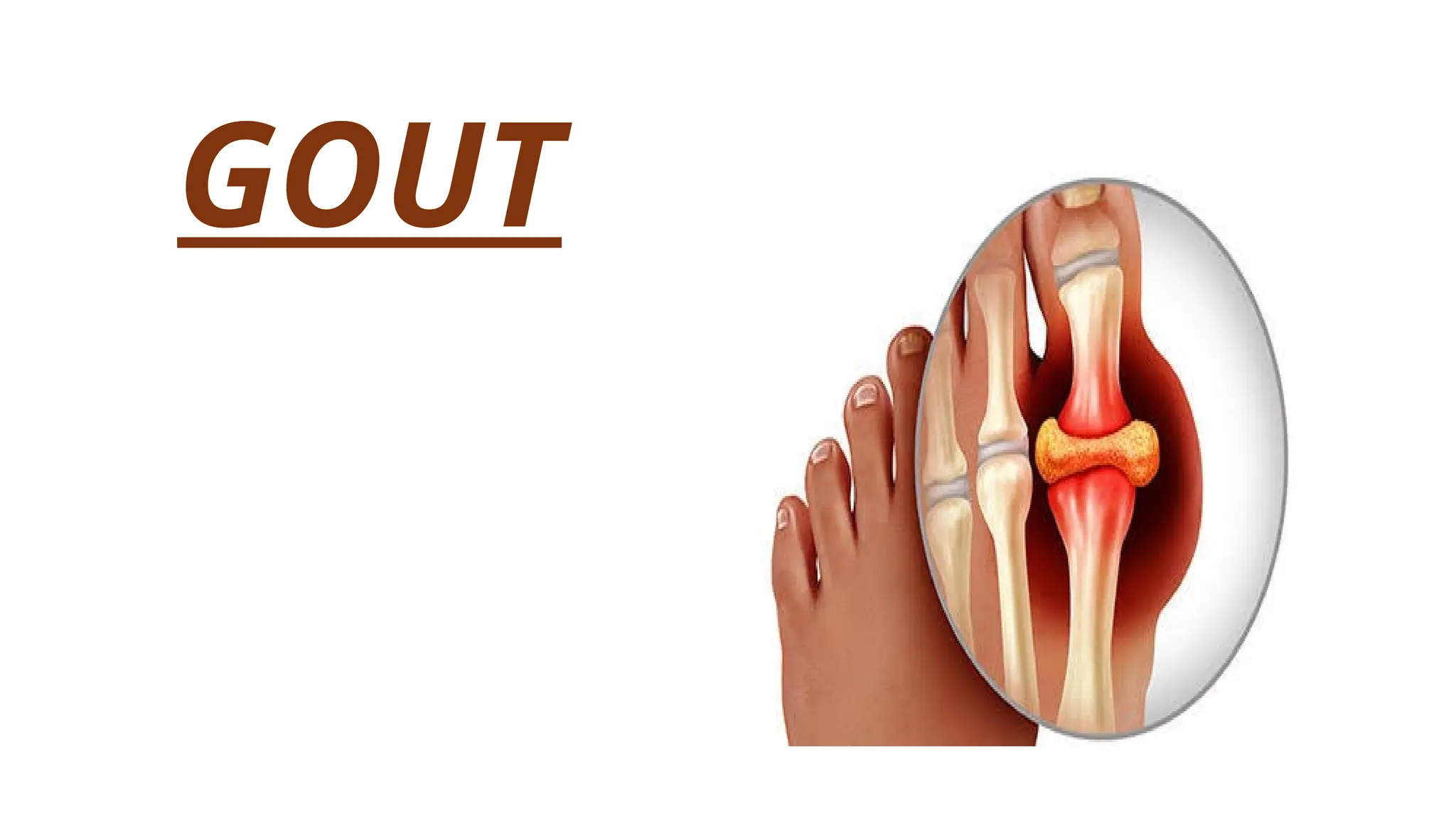 GOUT.definition, causes, pathogenesis, risk factor, clinical features, investigation, treatment ...