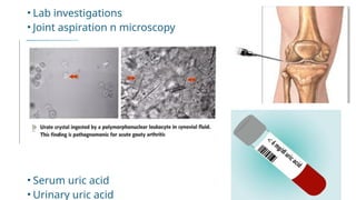 GOUT.definition, causes, pathogenesis, risk factor, clinical features ...