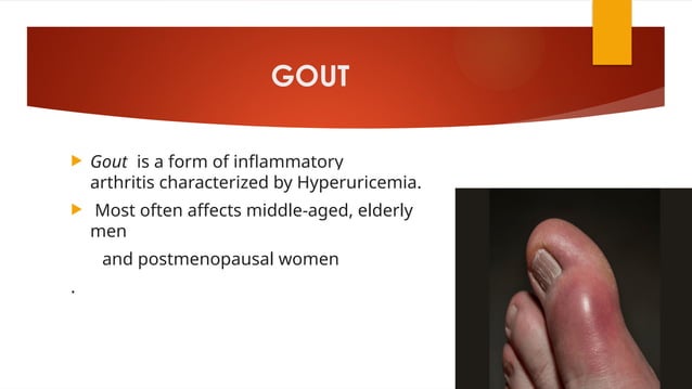 GOUT Definition Pathogenesis Clinical Features Treatment | PPT | Free ...