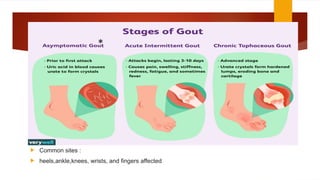 GOUT Definition Pathogenesis Clinical Features Treatment | PPT