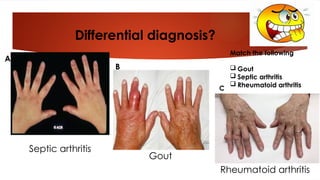Gout - inflammatory arthritis characterized by hyperuricemia. | PPT