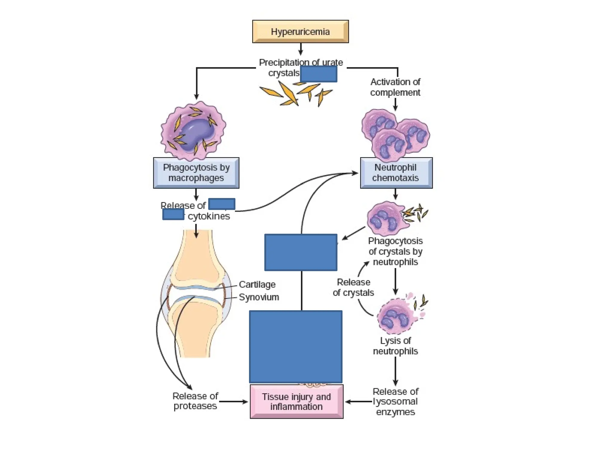 The Gout Attack: From Hyperuricemia to Joint Destruction and Modern ...