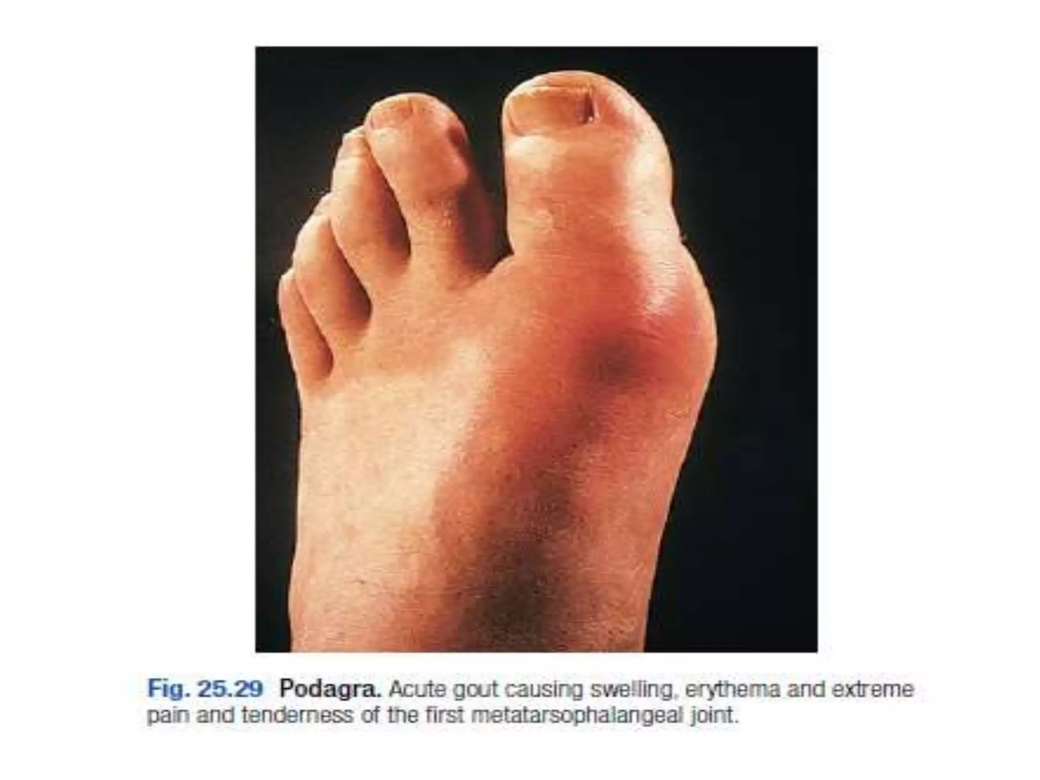 Hyperuricemia, Gout and Gouty Arthritis - Dhaval Joshi | PPTX