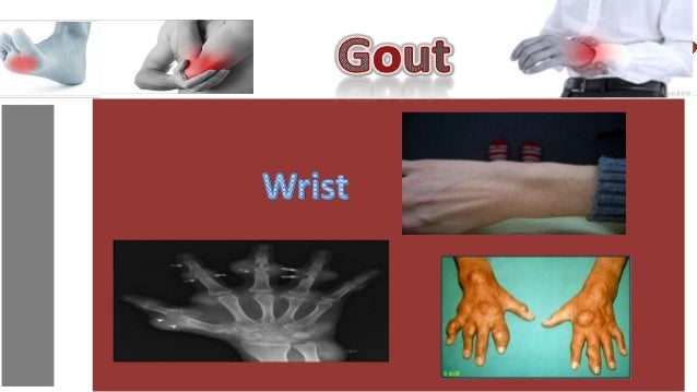 Gout