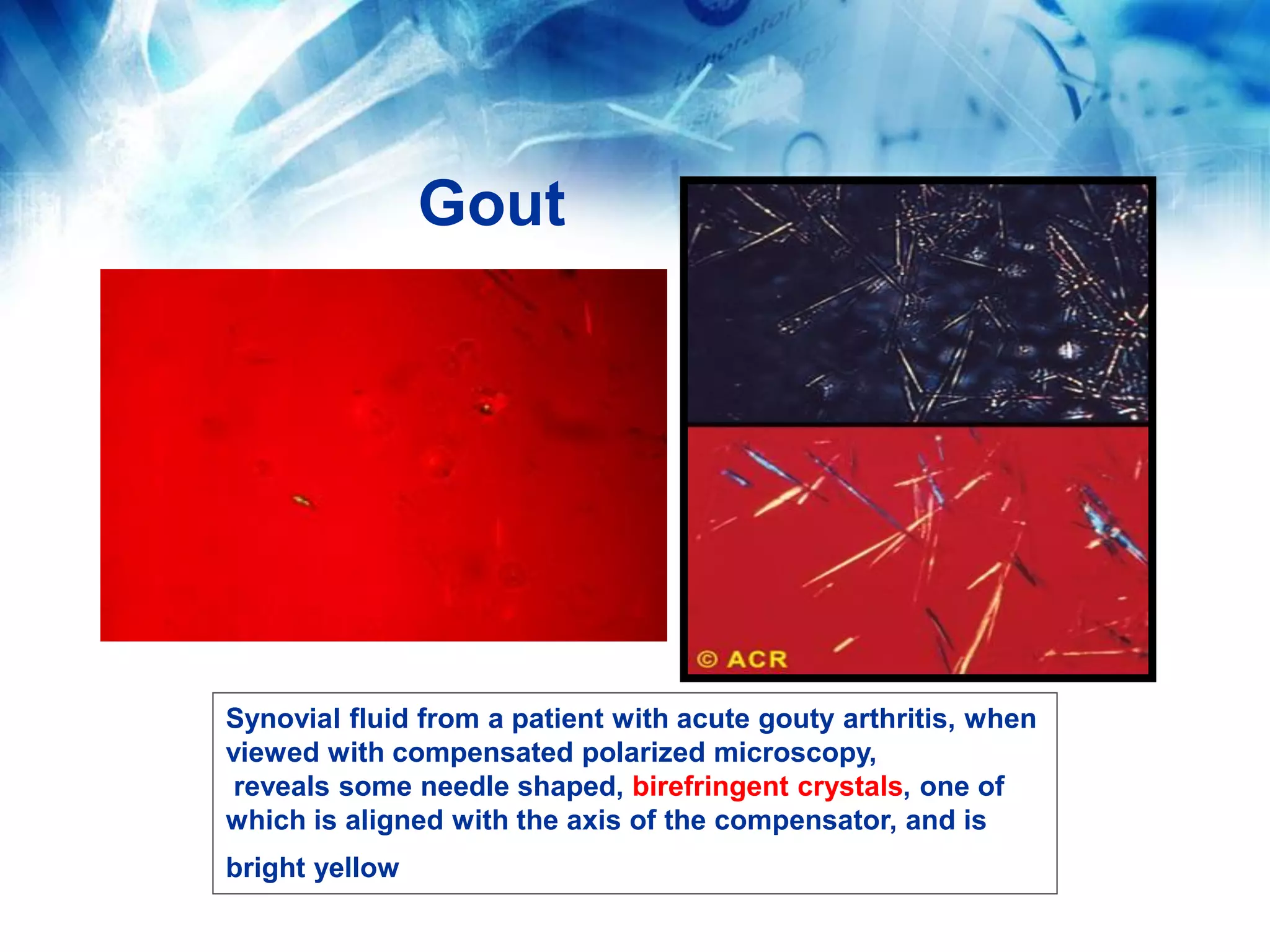 Gout Summery Updated 2020 American College Of Rheumatology Guideline | PDF