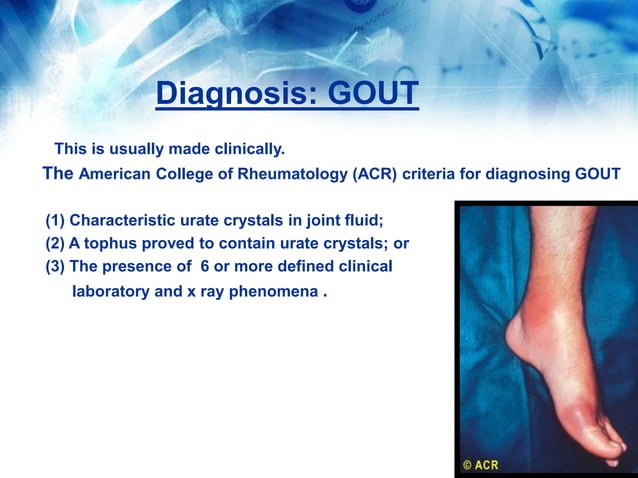 Gout Summery Updated 2020 American College Of Rheumatology Guideline ...