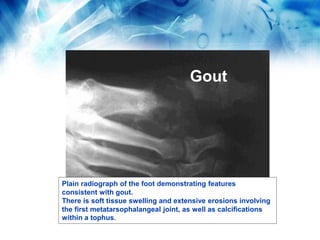 Gout Summery Updated 2020 American College Of Rheumatology Guideline | PDF