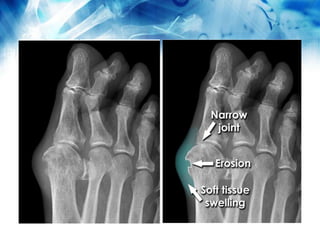 Gout Summery Updated 2020 American College Of Rheumatology Guideline | PDF