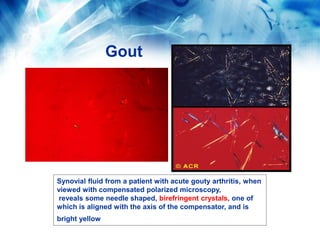 Gout Summery Updated 2020 American College Of Rheumatology Guideline | PDF