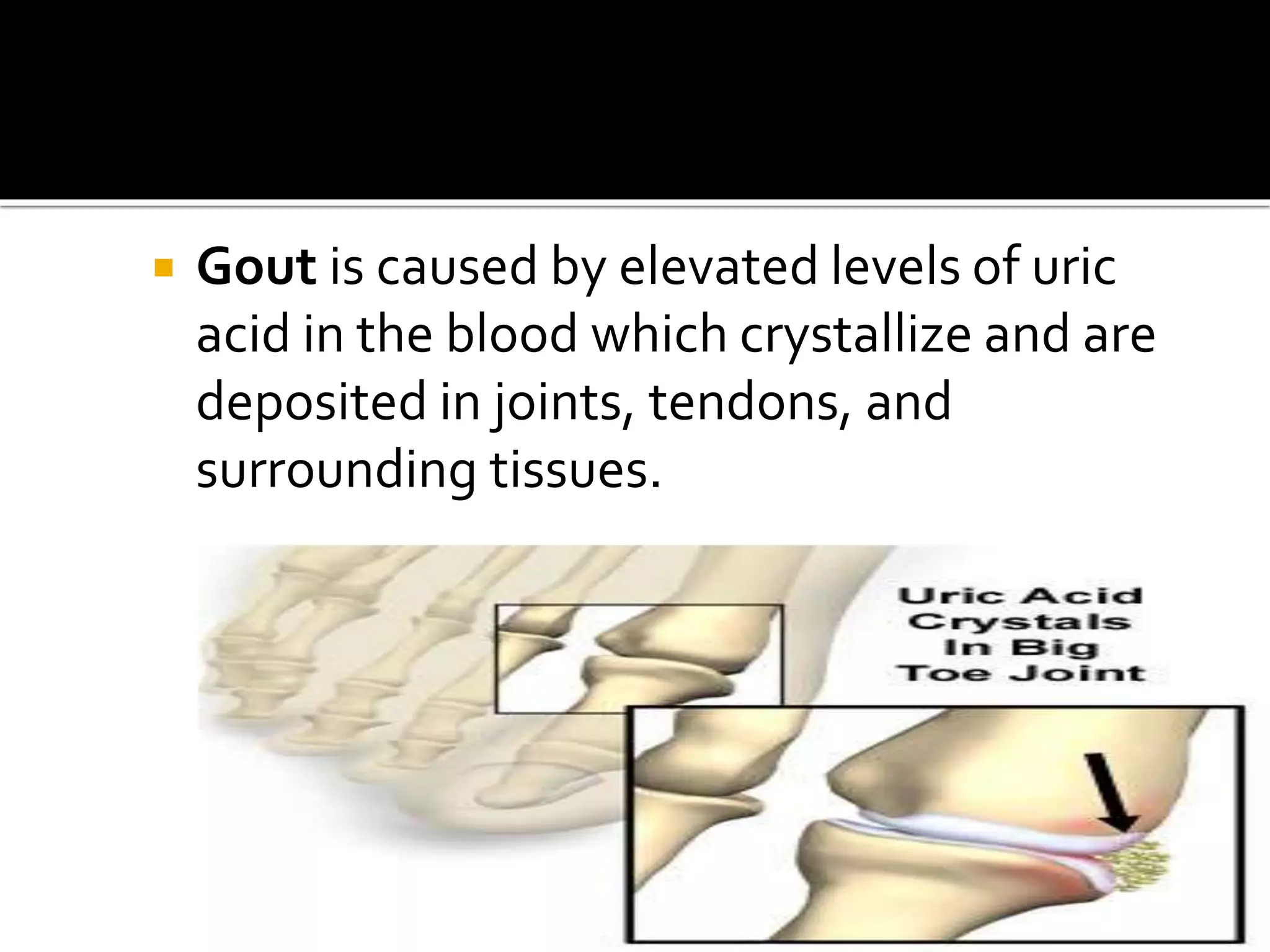 Gout and hyperuricemia | PPTX