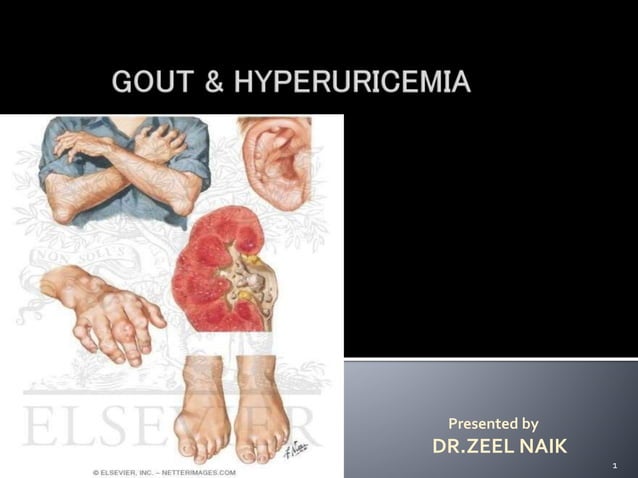 Gout and hyperuricemia | PPTX
