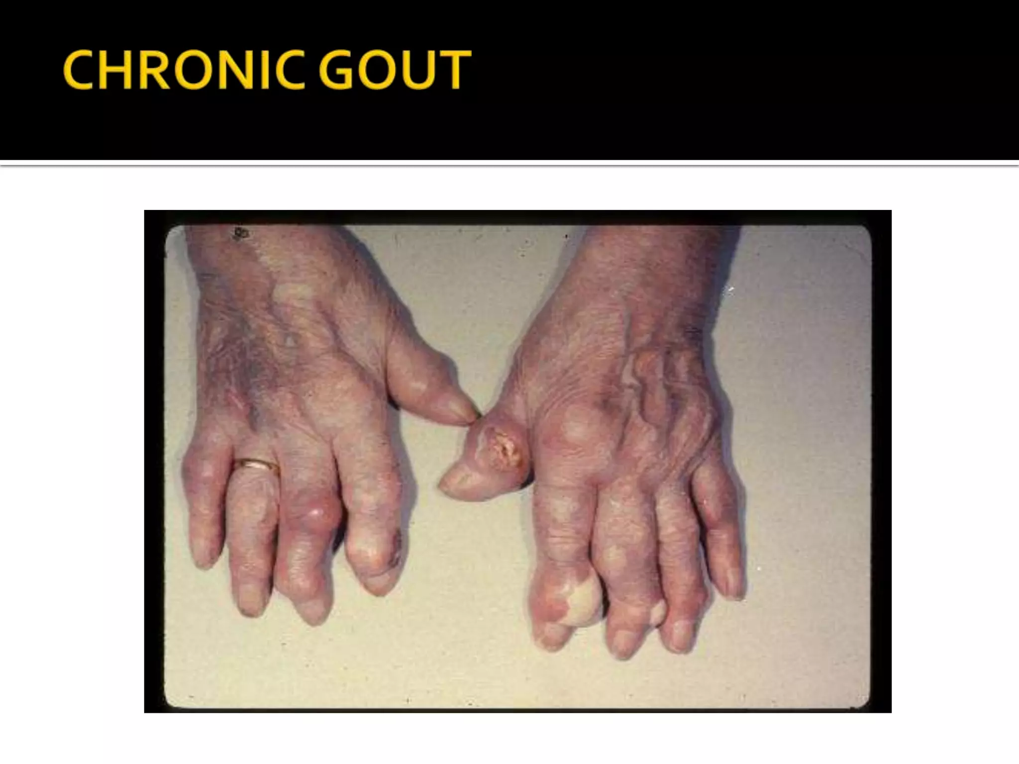 Gout and pseudogout | PPTX