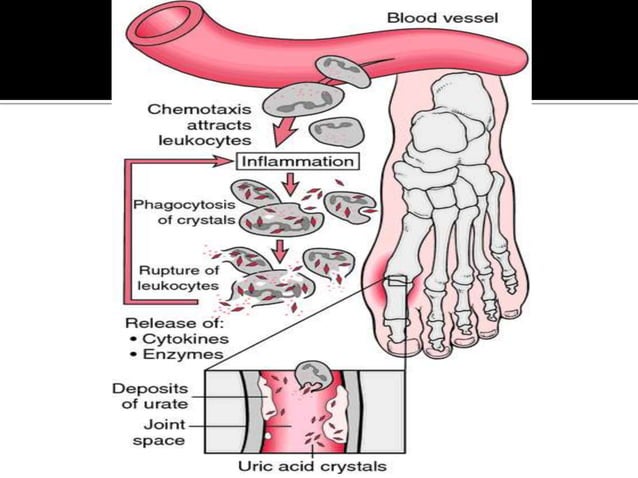 Gout and pseudogout | PPT