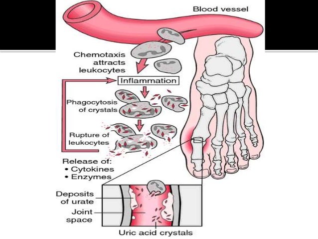 How To Treat Pseudogout | Pseudogout Symptoms And Treatment – REMOEQ