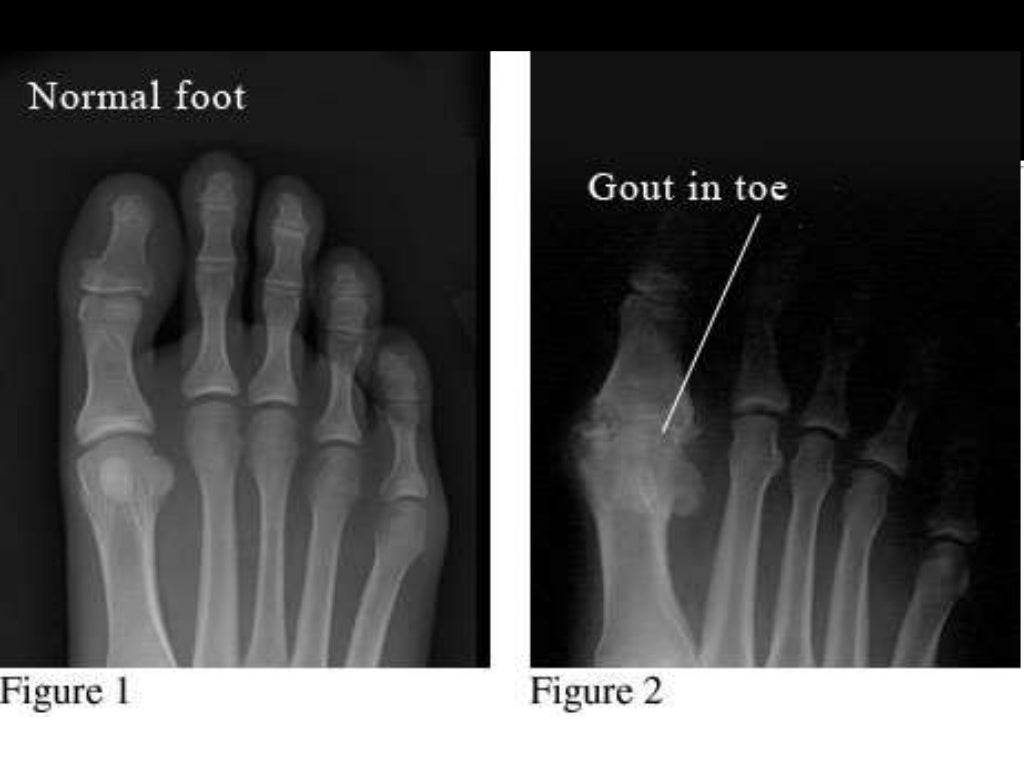 Gout and pseudogout