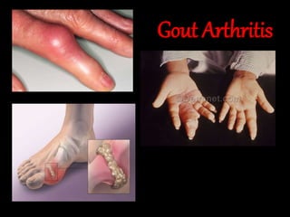 Gout arthritis mine | PPTX