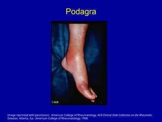 Gout disease 2025.pptx January pptdownload | PPTX