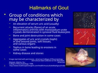 Gout disease 2025.pptx January pptdownload | PPT