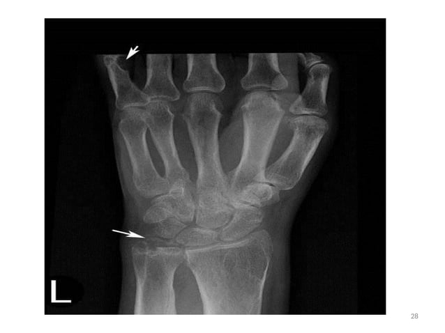 "Comprehensive Overview of Gout: Pathophysiology, Diagnosis, and ...