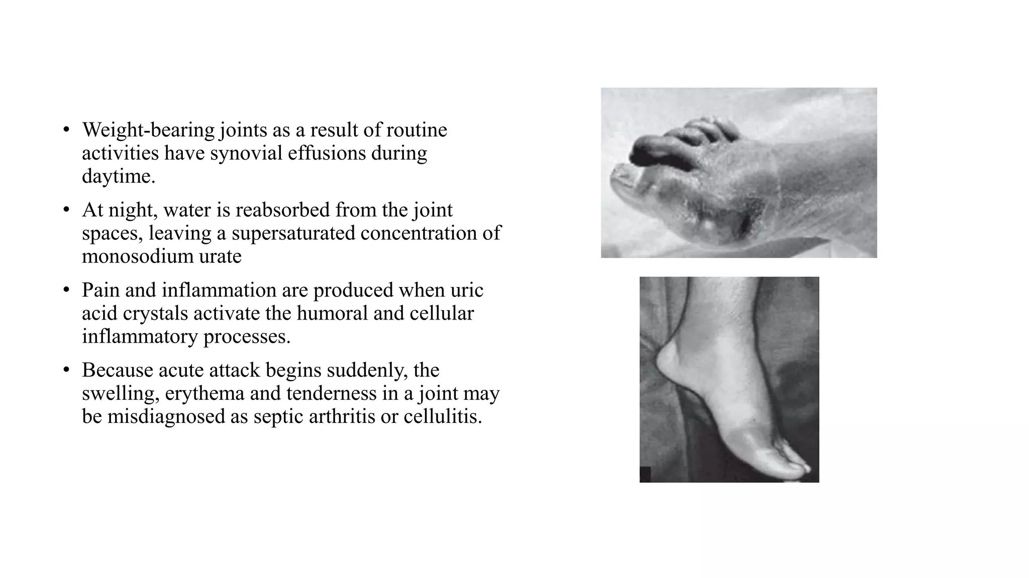 Gout and hyperuricemia | PPTX