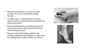 Gout and hyperuricemia | PPTX