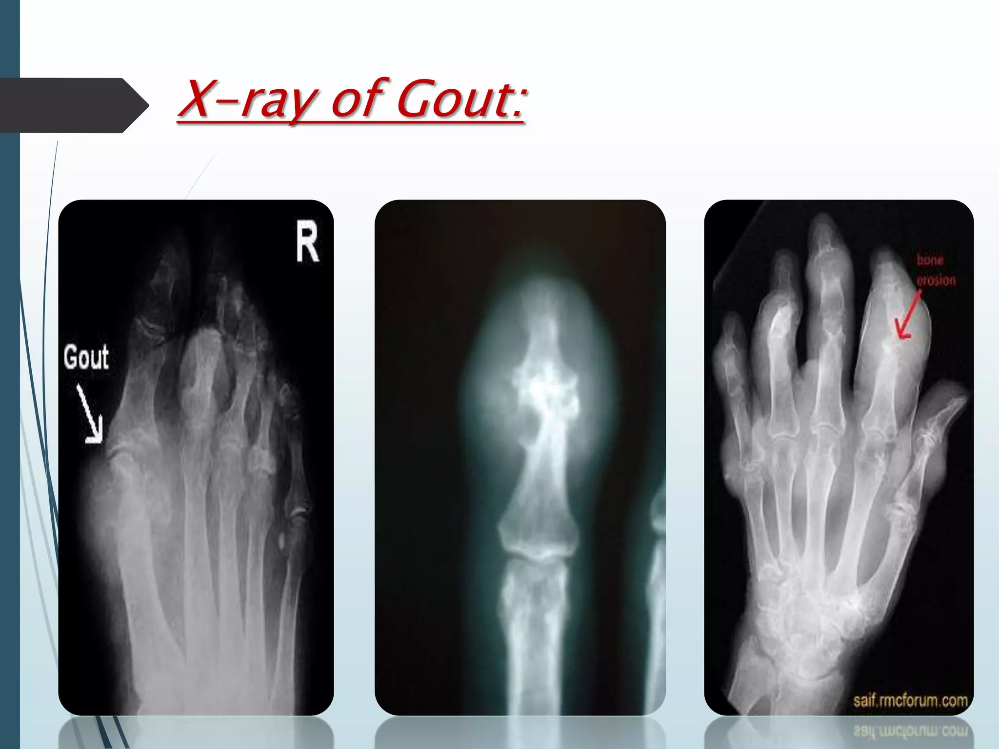 Gout management | PPTX