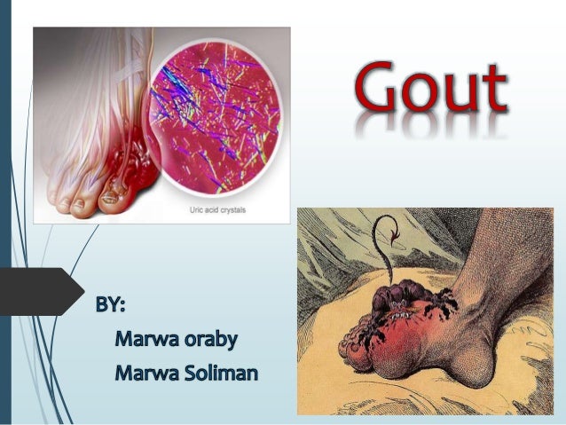 Gout management