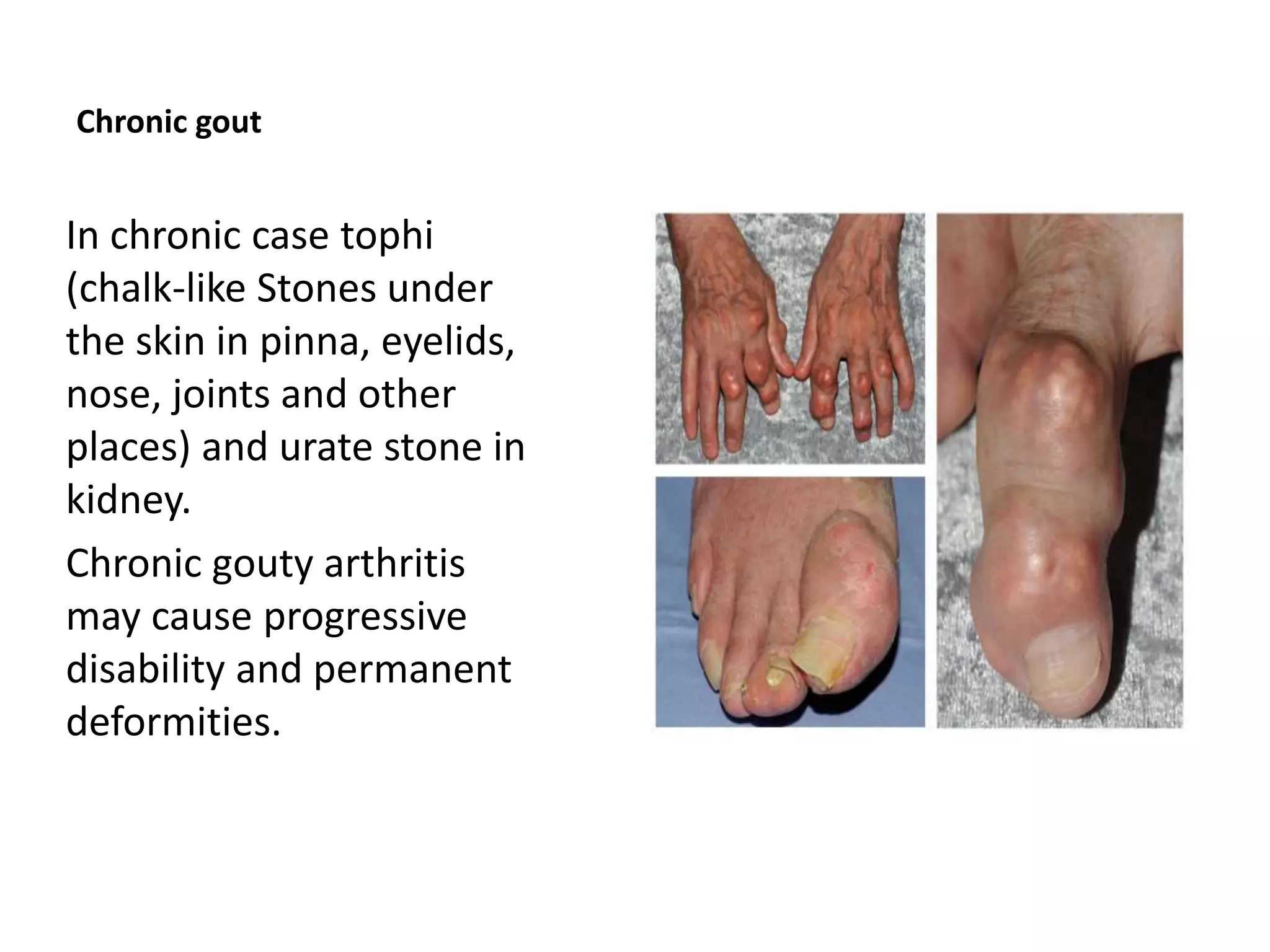 Gout pharmacotherapeutics.pptx