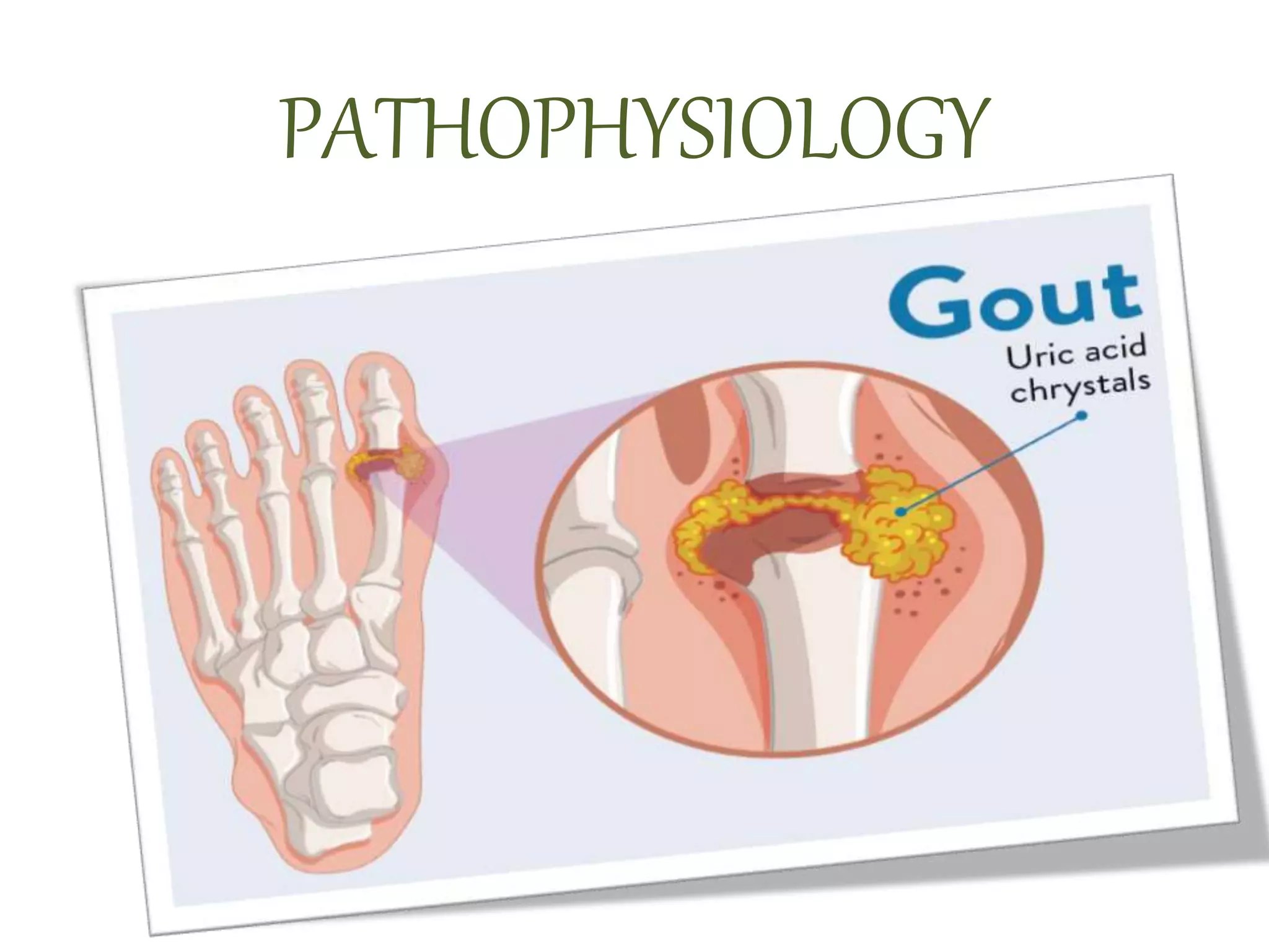 Gout ppt | PPTX