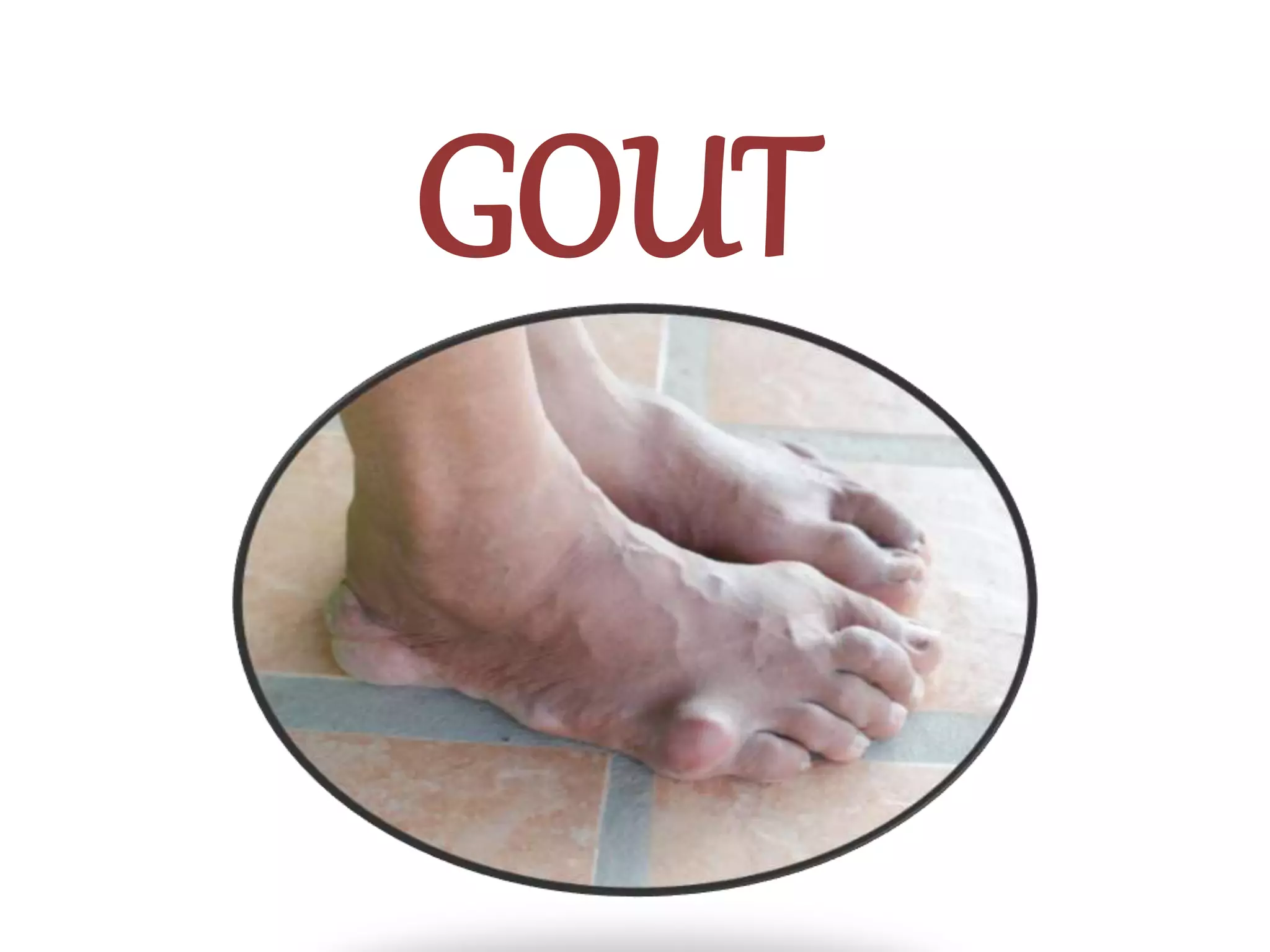 Gout ppt | PPTX