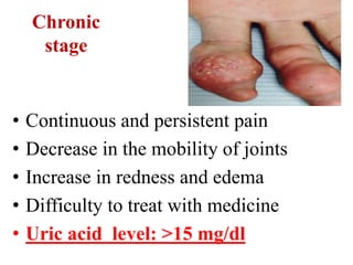 Gout ppt | PPTX
