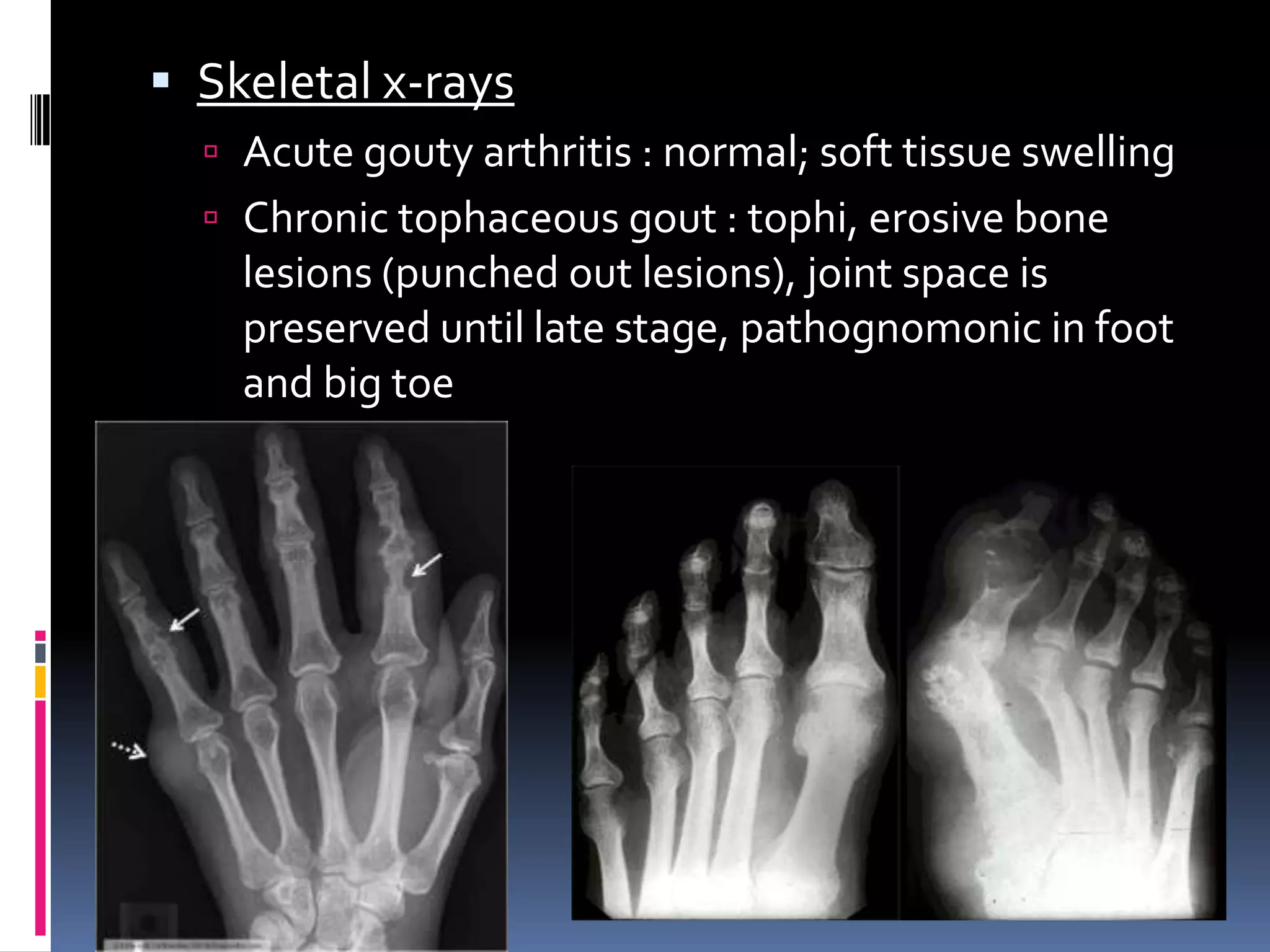 Gout presentation | PPTX