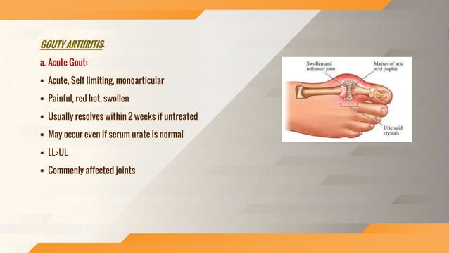 Gout presentation | PPT