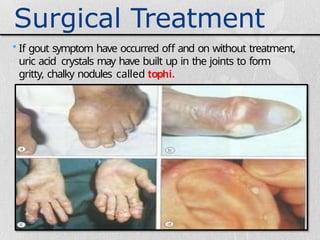 gout, causes, types, signs and symptoms and mgmt | PPT