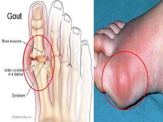 gout, causes, types, signs and symptoms and mgmt | PPT