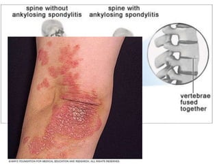 Gout and Rheumatoid arthritis (RA) | PPTX