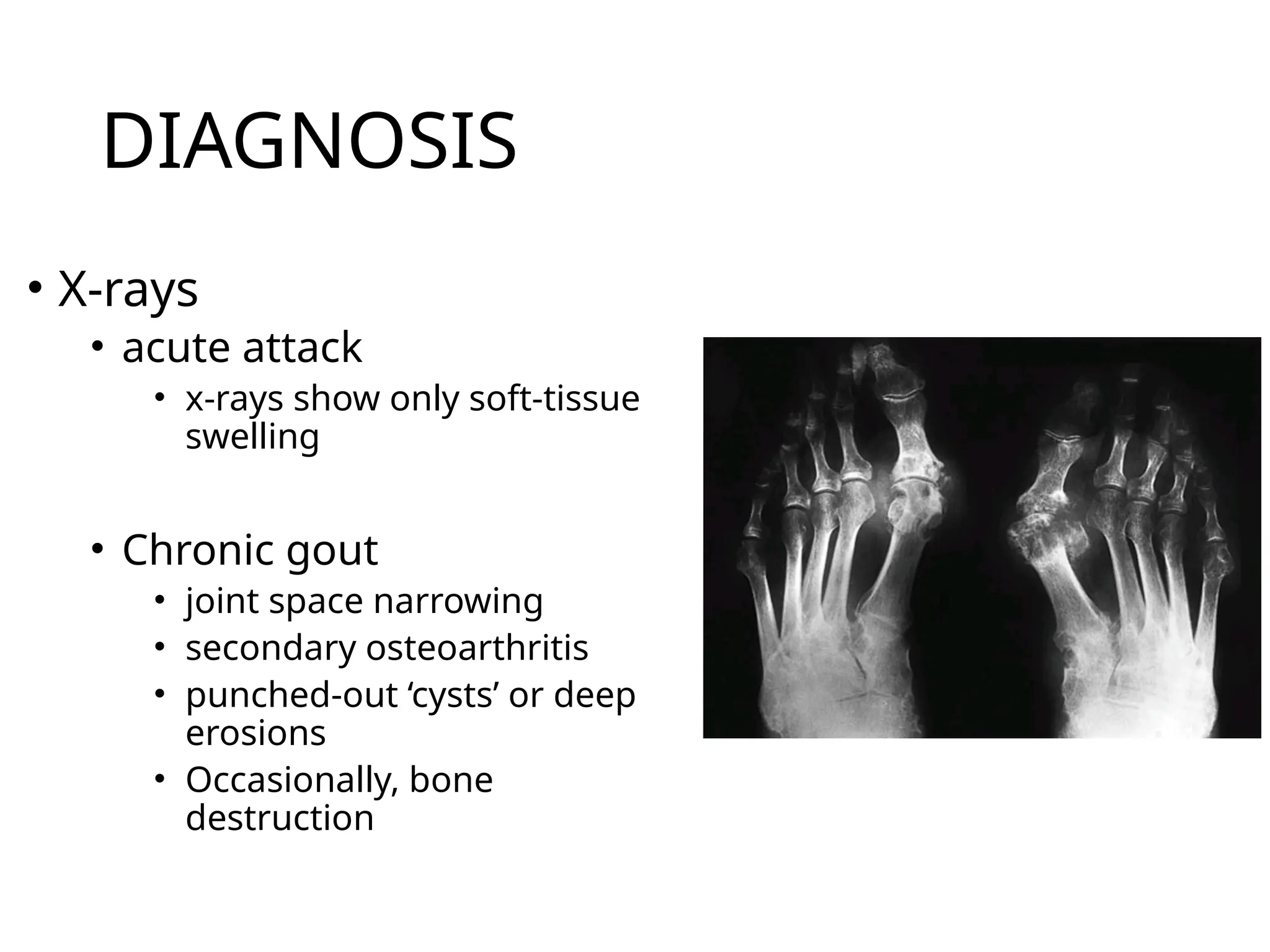 Gout-definition-clinical pictures-diagnosis-treatment | PPTX