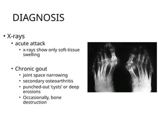 Gout-definition-clinical pictures-diagnosis-treatment | PPTX