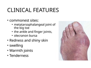 Gout-definition-clinical pictures-diagnosis-treatment | PPTX