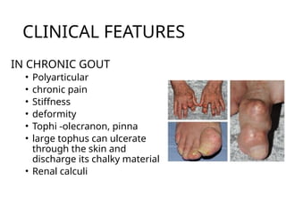 Gout-definition-clinical pictures-diagnosis-treatment | PPTX