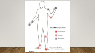 GOUTY ARTHRITIS | PPT
